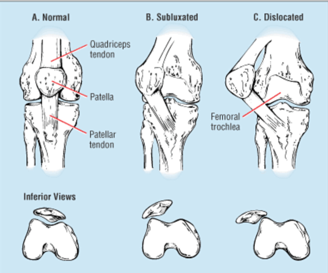 Patella (Kneecap) Dislocation / Instability - Active Physio Dalby